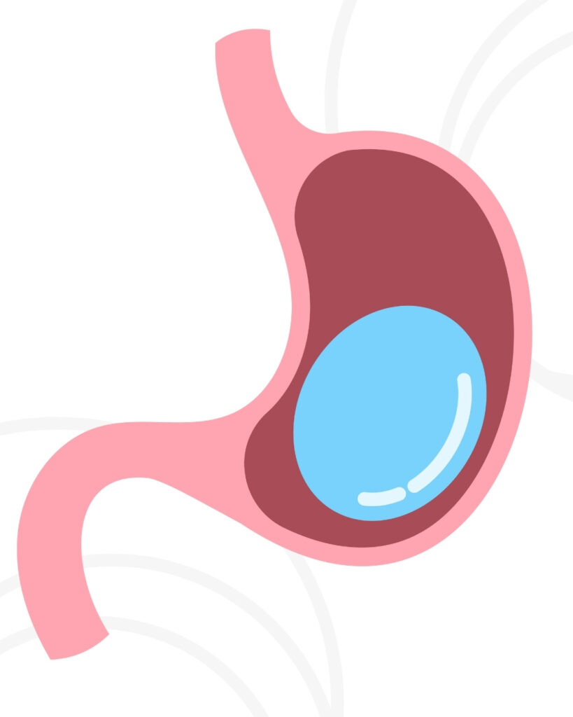Intragastric Balloon Procedure - Dr. Joya Obesity Center